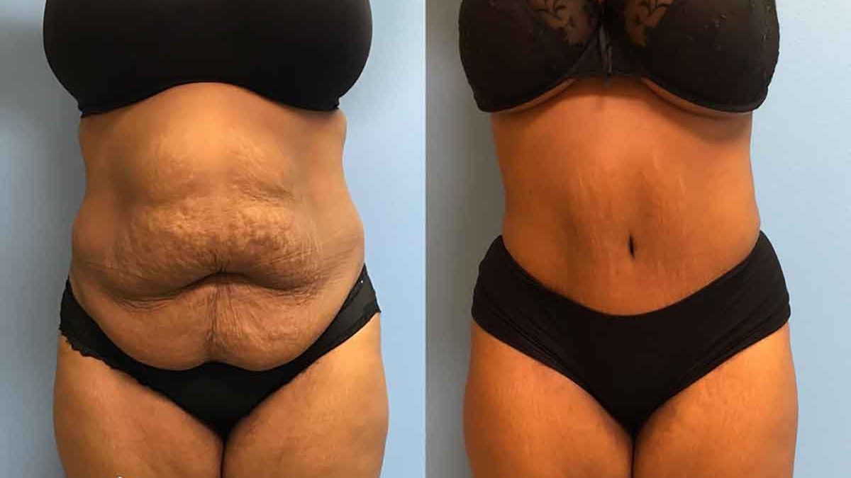 37 F After Tummy Tuck with Lipo 360 - Petrungaro Plastic Surgery
