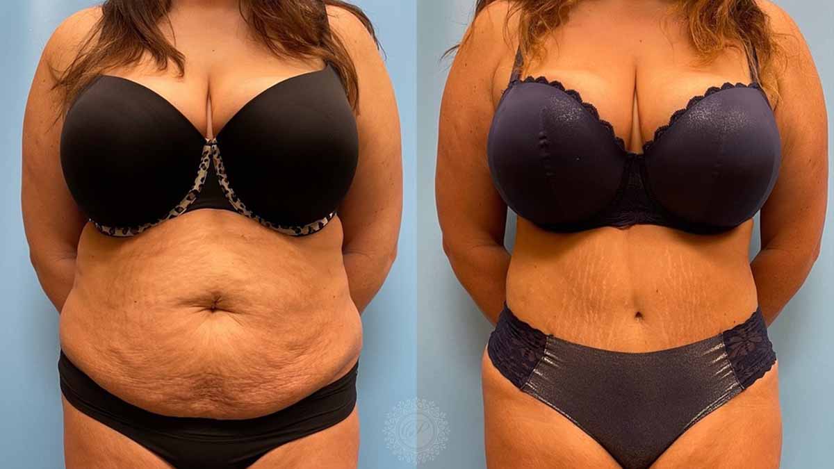Tummy Tuck & Lipo 360 - Petrungaro Plastic Surgery Tummy Tuck & Lipo 360 - Petrungaro Plastic Surgery