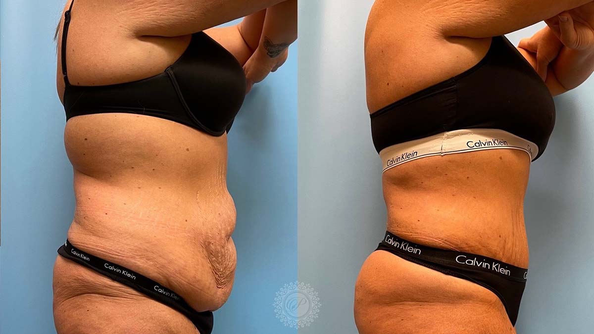 Tummy Tuck, Lipo 360 & Brazilian Butt Lift - Petrungaro Plastic Surgery