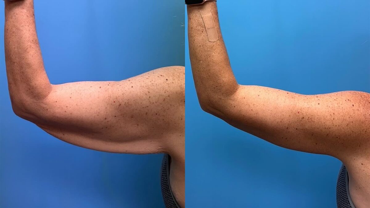 50F Year Old Woman Before and After Extended Arm Lift - Petrungaro ...